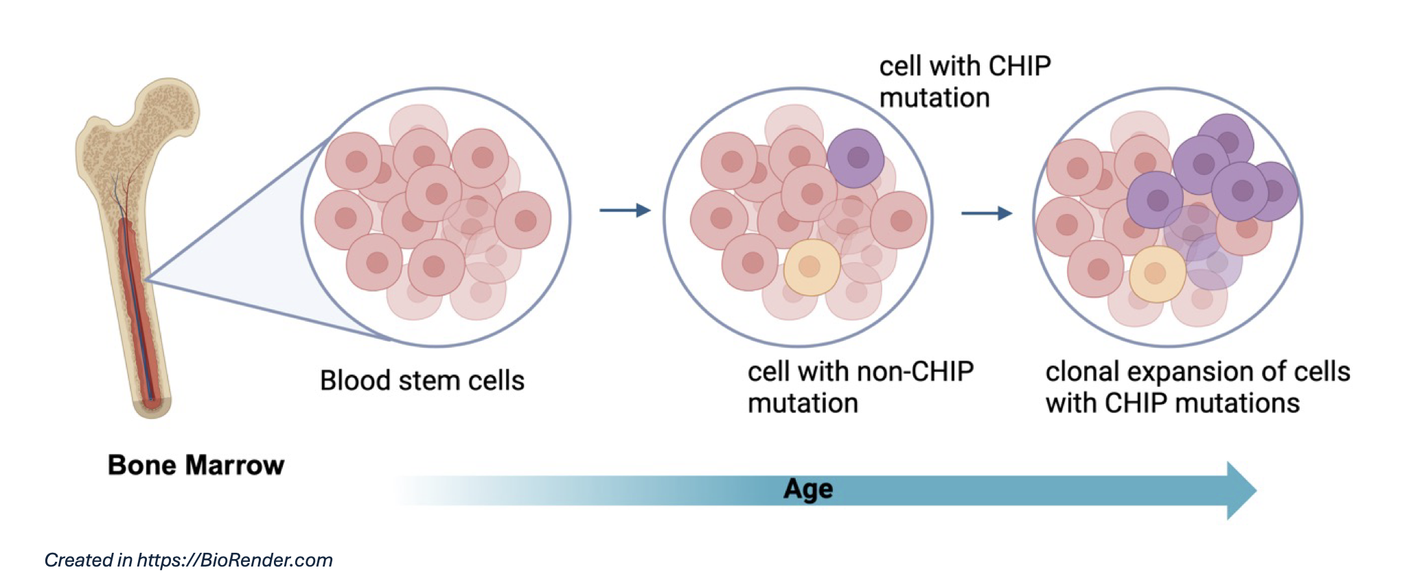 Clonal Hematopoiesis of Indeterminate Potential (CHIP) Center | UCSF Cardiology